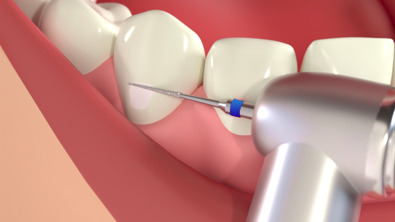 Composite Attachment Burs – 1122CORP