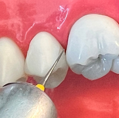 Diamond Burs 1122corp