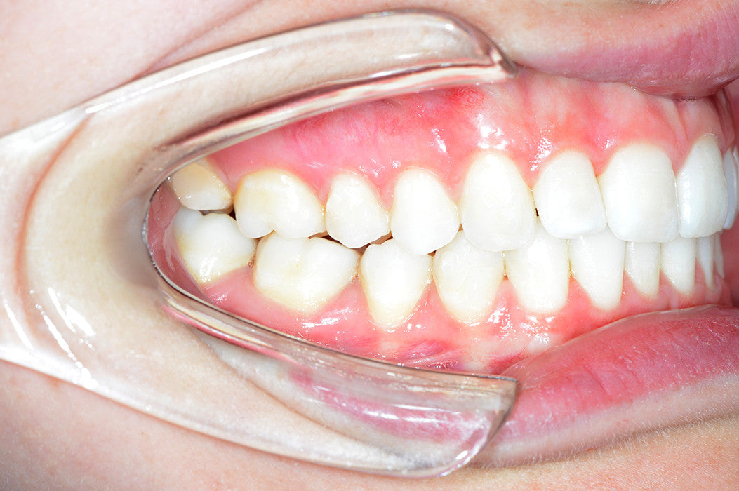 CLEAR Plastic Buccal Cheek Retractor 1, 10, 20 packs - 1122CORP